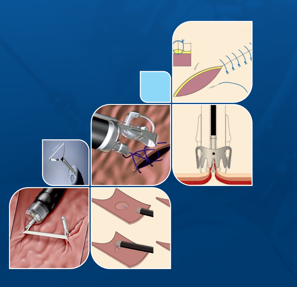 Endoscopic Closure Techniques 2025